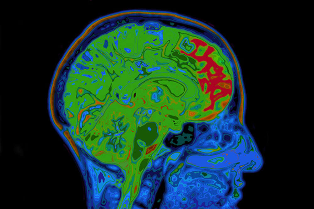 Understanding Frontotemporal Dementia Understanding Frontotemporal Dementia